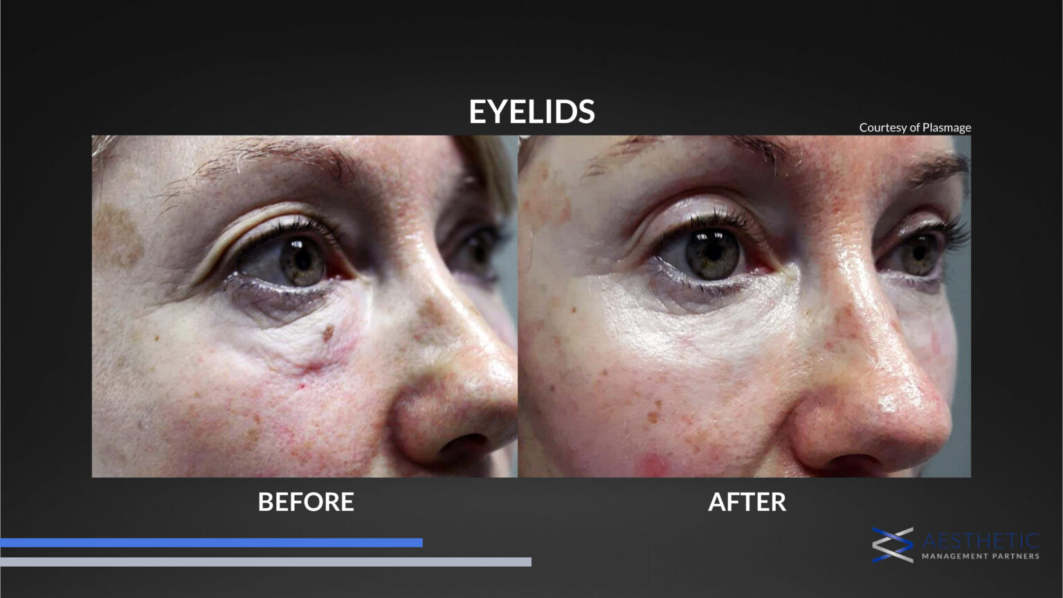 Plasmage for Hooded Eyes: Addressing Upper Eyelid Concerns Without Surgery